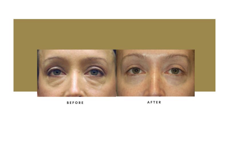 The Difference Between Surgical and Non-Surgical Brow Lift | Julie ...